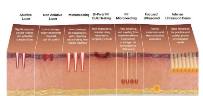 Latest Anti-aging Technology-Sofwave