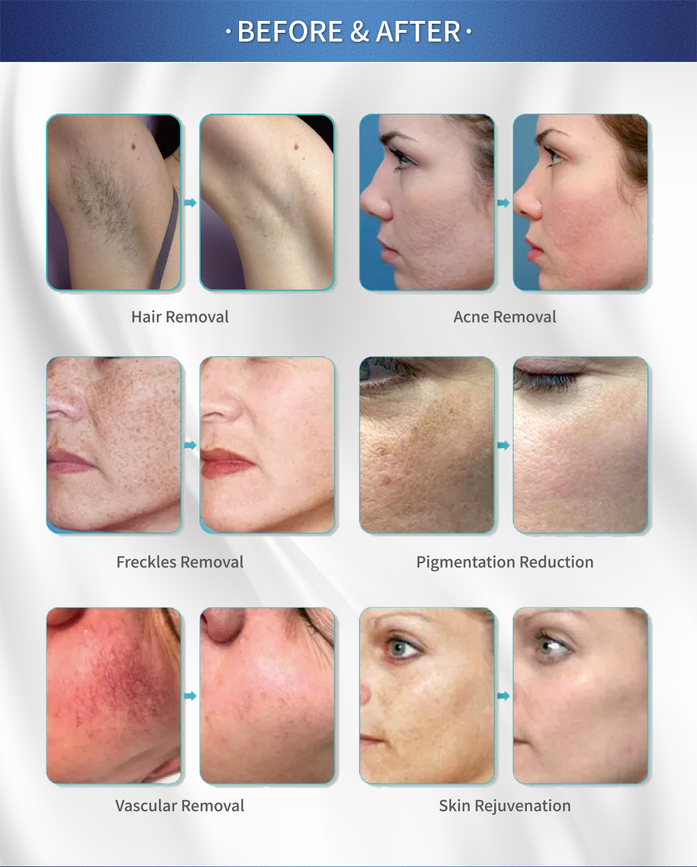 OPT Hair Removal Machine With 3 filters : 480nm,530nm,640nm